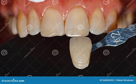 Determination Of Tooth Color Using A Sample On A Black Background