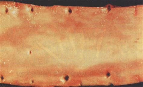 第一节 动脉粥样硬化 病理学与病理生理学