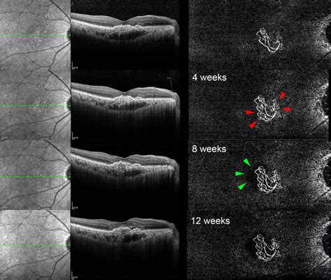 Representative Case Showing The Nonexudative Growth Of Choroidal Download Scientific Diagram