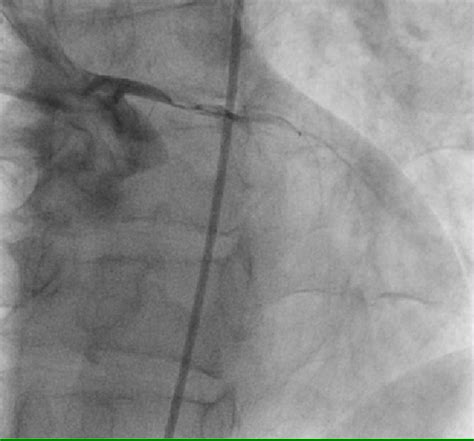 Dr Smiths Ecg Blog Refractory V Fib Arrest Put On Ecmo Regains An