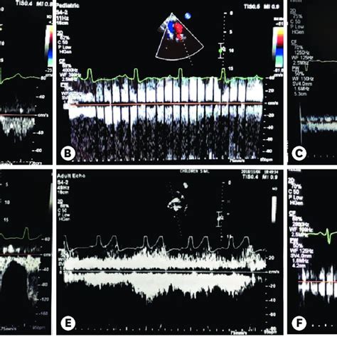Examples Of Doppler Flow Patterns In Pa Branches Of 6 Modifications Of Download Scientific