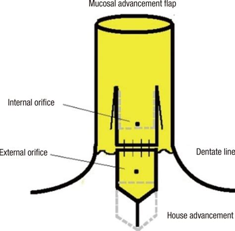 Schematic Illustration Of The Anatomy Of The Anal Canal After The