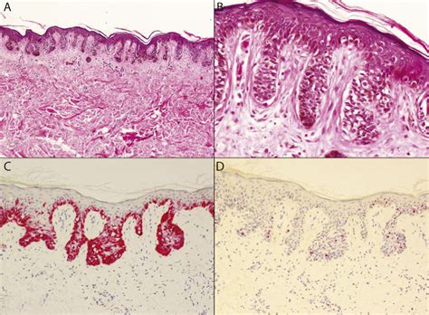 Epidermal Nevus Histology