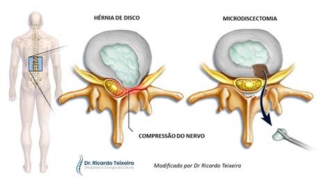 Hérnia de Disco Lombar - Dr. Ricardo Teixeira
