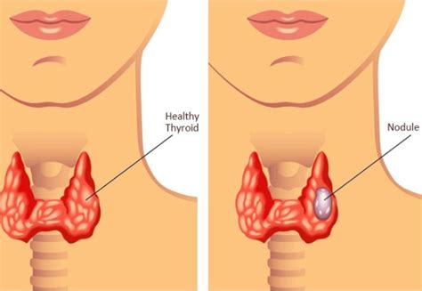 Goiters And Thyroid Nodules Key Differences Causes