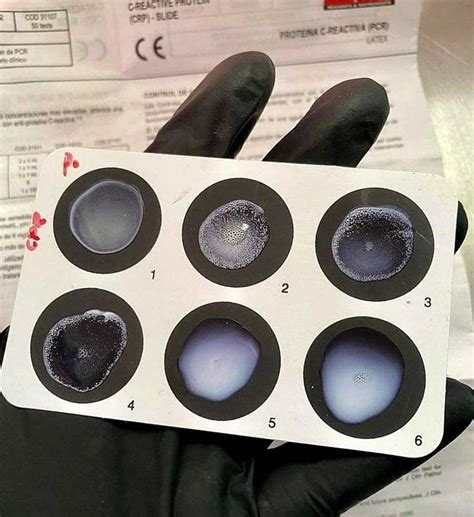 Linkedincommunity Crp Inflammation Medicallaboratory Diagnostics Patientcare