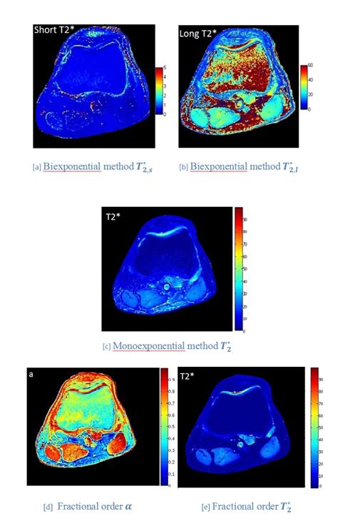 Figure 2 T2 Maps Of The Biexponential Method A And B The Figure 2 T2 Maps Of The Biexponential Method A And B The
