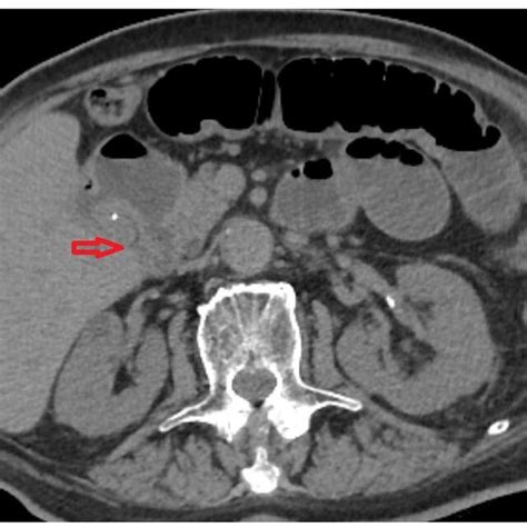 Ct Scan Of The Abdomen Showing Abnormal Communication Between Download Scientific Diagram