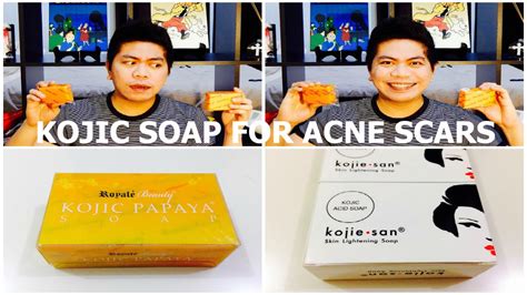 Best Soap For Acne Scars At Andre Thompson Blog