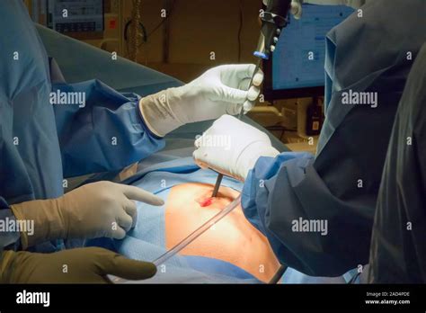 Appendix Removal Surgery Surgeon Inserting A Laparoscope Through The Umbilical Port During
