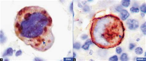 Immunocytochemistry Of Effusion Fluids Introduction To Scip Approach Cytojournal