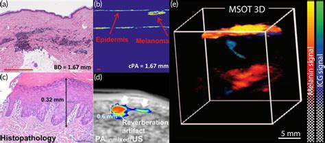 Photoacoustic Computed Tomography Pact Imaging Of Melanoma A B Download Scientific Diagram
