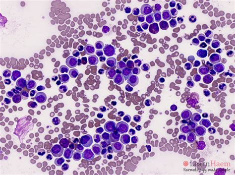 Cml In Chronic Phase Learnhaem Haematology Made Simple