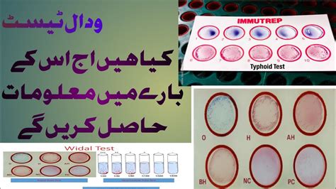 What Is Widal Test Result Widal Test Youtube