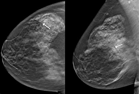 Outcome Of Architectural Distortion Detected Only At Breast Tomosynthesis Versus 2d Mammography