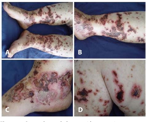 Figure 1 From Ulcerative Iga Vasculitis In The Setting Of Warfarin