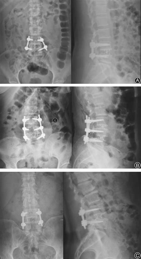Anterioposterior And Lateral X‐ray Film After Oblique Lumbar Interbody Download Scientific