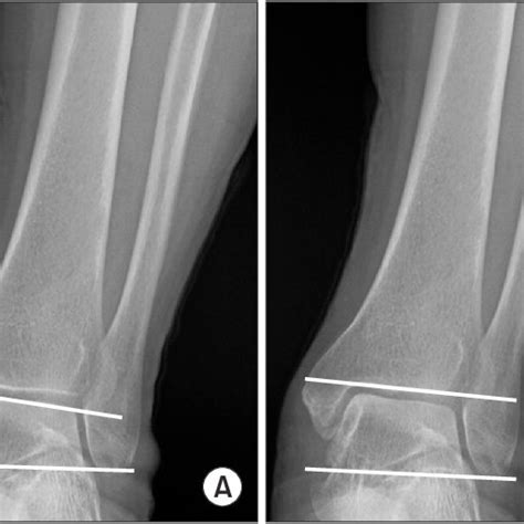 Weight Bearing Line Wbl Joint Line Convergence Angle Jlca Knee