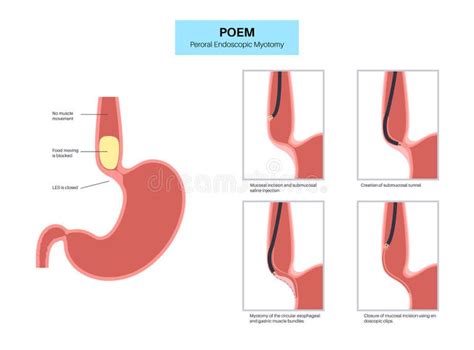 Myotomy Stock Illustrations 29 Myotomy Stock Illustrations Vectors