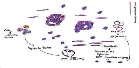 does tumor stroma ratio of breast cancer trucut biopsy deter