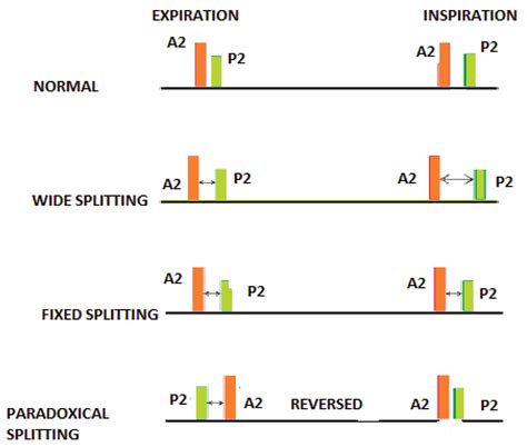 Second Heart Sound Indian Journal Of Cardiovascular Disease In Women