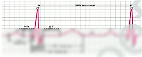 Solution Waves And Intervals Making Up The Ecg Ecg Electrocardiography