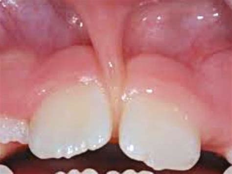 Frenectomy Pictures Before And After