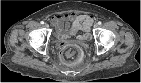 Axial Computed Tomography Image Of Sigmoido Rectal Intussusception With