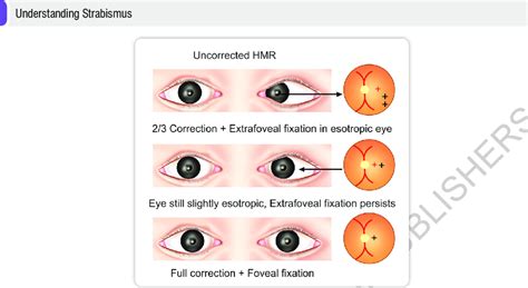 4 Principle Of Correction Of Hypermetropia If Only 23 Of