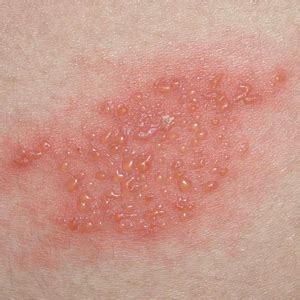 The Diagnosis And Management Of Herpes Zoster Bpj 59 March 2014