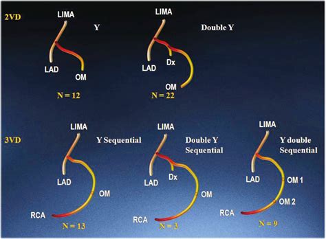 Comparison Of The Radial Artery And Saphenous Vein As Composite Grafts