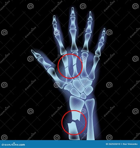 Fracture Of The Metacarpal And Radius Bones Vector Illustration