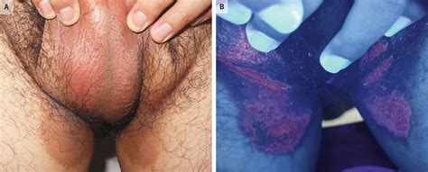 Inguinal Erythrasma MEDizzy