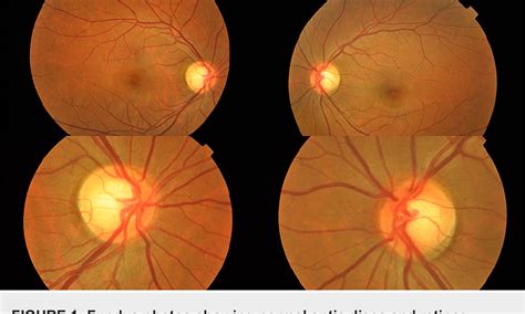 Figure 1 From A Rare Occurrence Of Craniopharyngioma Causing Visual