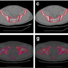 Example Of Segmentation Results Using Proposed Method In The Fracture Download Scientific