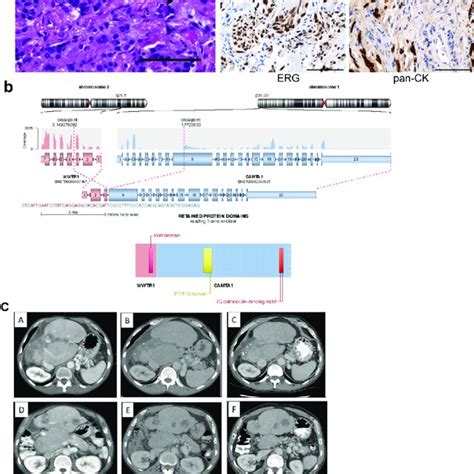 Analysis Of Case 130 A Ffpe Sections From Tumour 130 Were Assessed Download Scientific