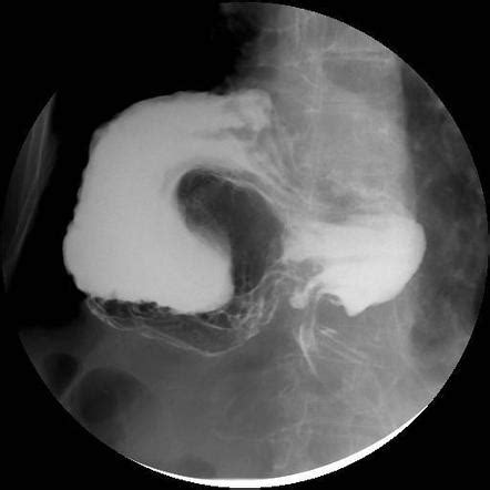 Volvulus Radiology