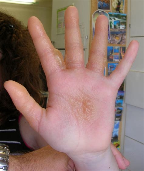 Phytophotodermatitis