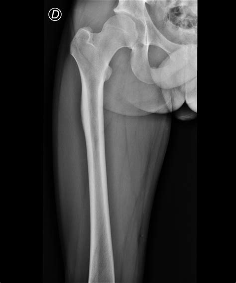 Osteoid Osteoma Femur