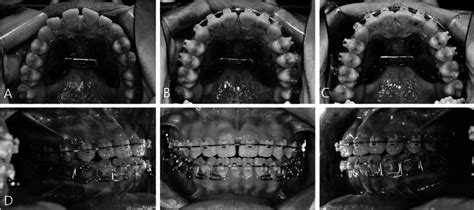 C Expander For Maxillary Expansion And Its Utilization For Indirect Download Scientific Diagram