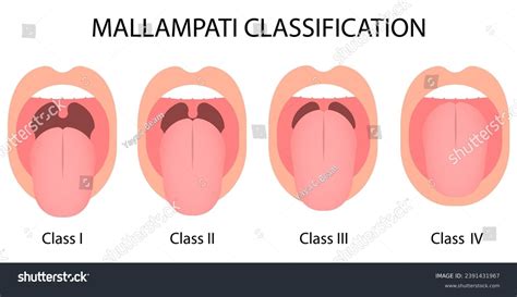 Mallampati Classification Score Oral Airway Intubation Stock Vector