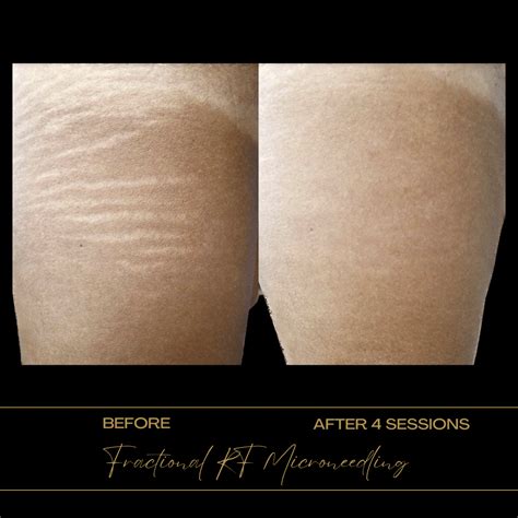 Fractional Radiofrequency Microneedling Beauty Empire 33615