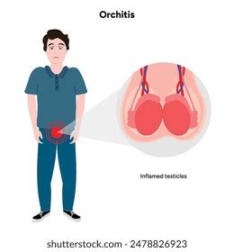 Orchitis Inflamed Normal Testicles Sad Man Stock Vector Royalty Free
