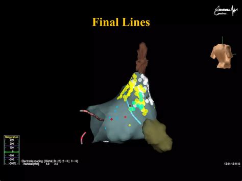 Ablation Of Atypical Flutter Pptx