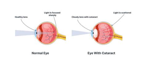 Glaucoma Vs Cataract Whats The Difference Laxmi Eye Hospital