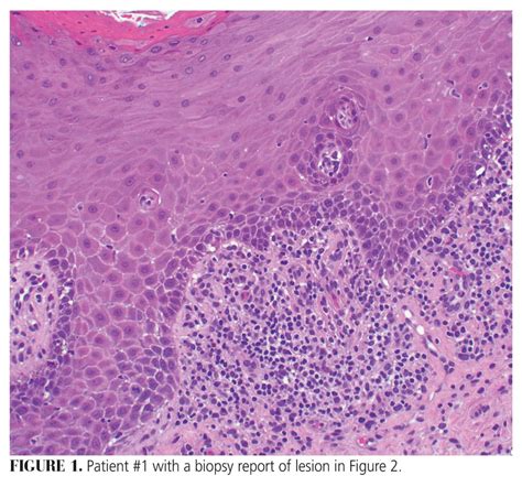 043lichen Planus Ce42 45 Page 43 2 Decisions In Dentistry