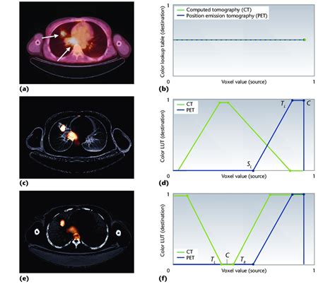 Application Of Dual LUT Transfer Function To PET CT Images A And B Download Scientific