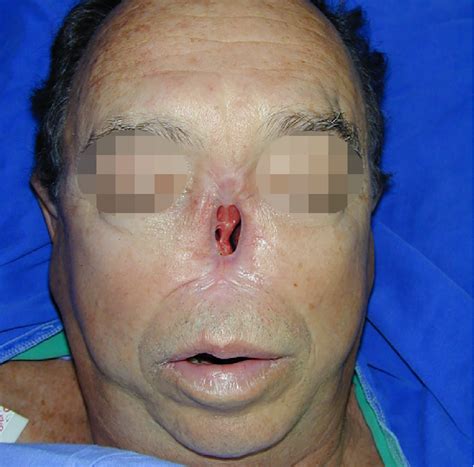 Preoperative Aspect Consequence Of Total Rhinectomy Due To Squamous