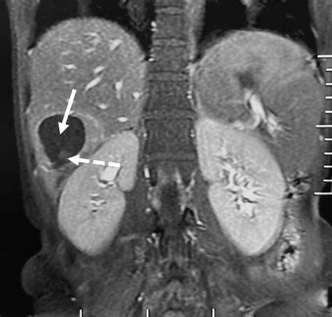 Fate Of Hepatic Ectopic Pregnancy 1 Year Post Treatment Still Visible