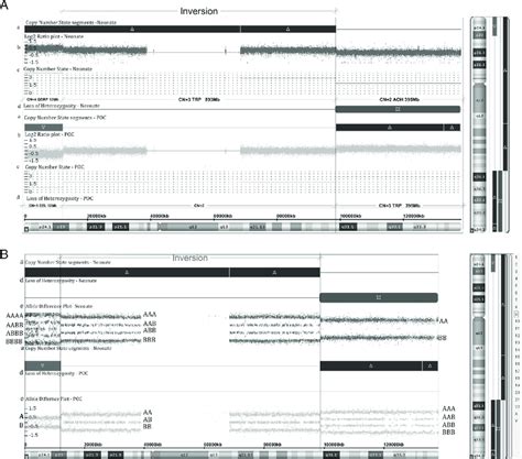 Results Of Snp Microarray Analysis Affymetrix Cytoscan™ Hd Suite With Download Scientific